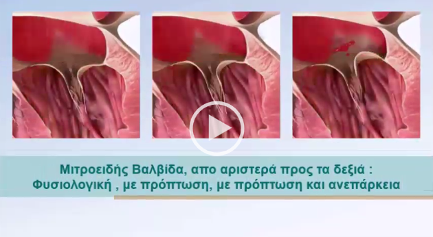 Η ΠΡΟΠΤΩΣΗ ΤΗΣ ΜΙΤΡΟΕΙΔΟΥΣ ΒΑΛΒΙΔΑΣ | Καρδιολογία