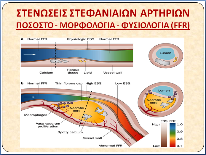 Η ΣΤΑΘΕΡΗ ΣΤΕΦΑΝΙΑΙΑ ΝΟΣΟΣ ΚΑΙ Η ΙΣΧΑΙΜΙΑ ΤΟΥ ΜΥΟΚΑΡΔΙΟΥ (ΤΟ FFR, TO ...
